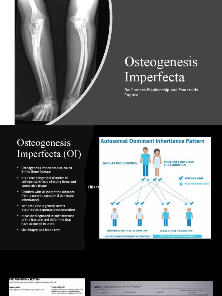 Diagnostik Und Therapie Der Osteogenesis Imperfecta – GSJWXX