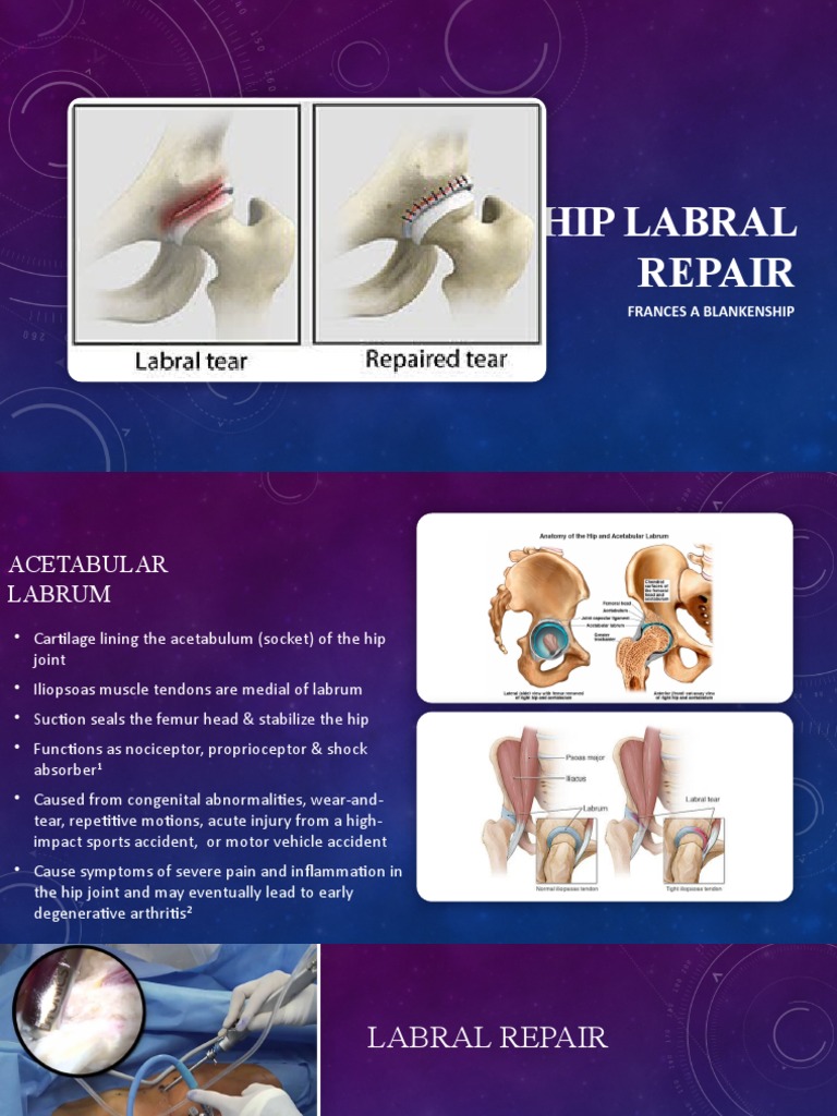 Hip Labral Repair Presentation | PDF | Diseases And Disorders | Medicine