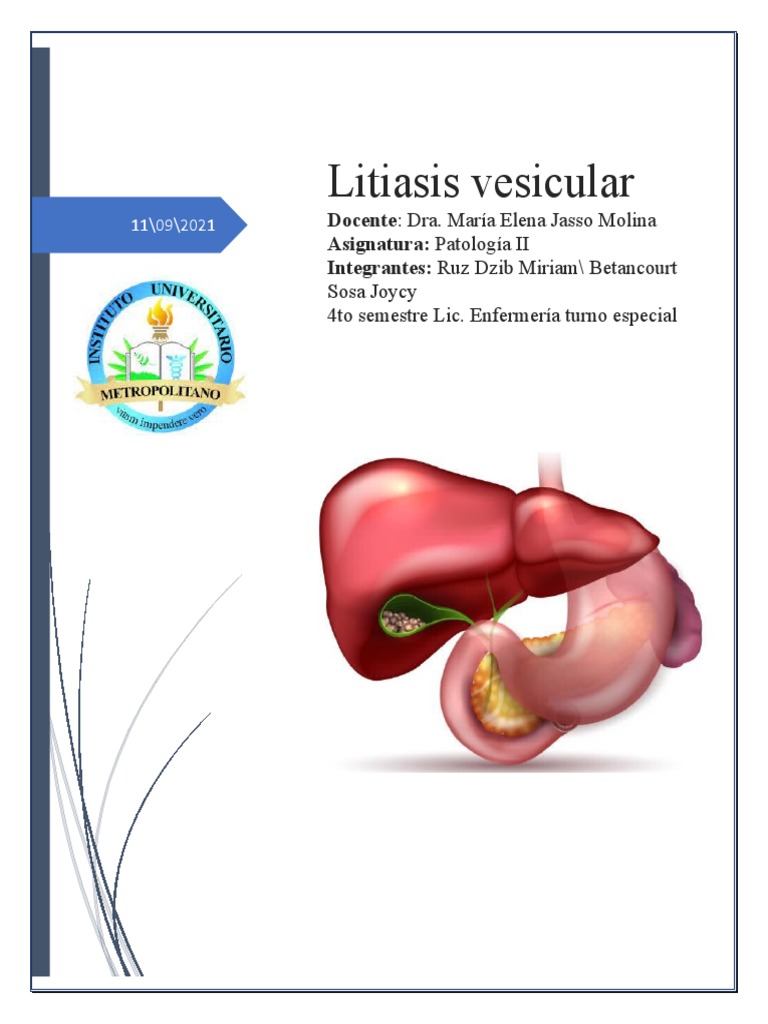 Litiasis Vesicular | PDF | Vesícula biliar | Bilis