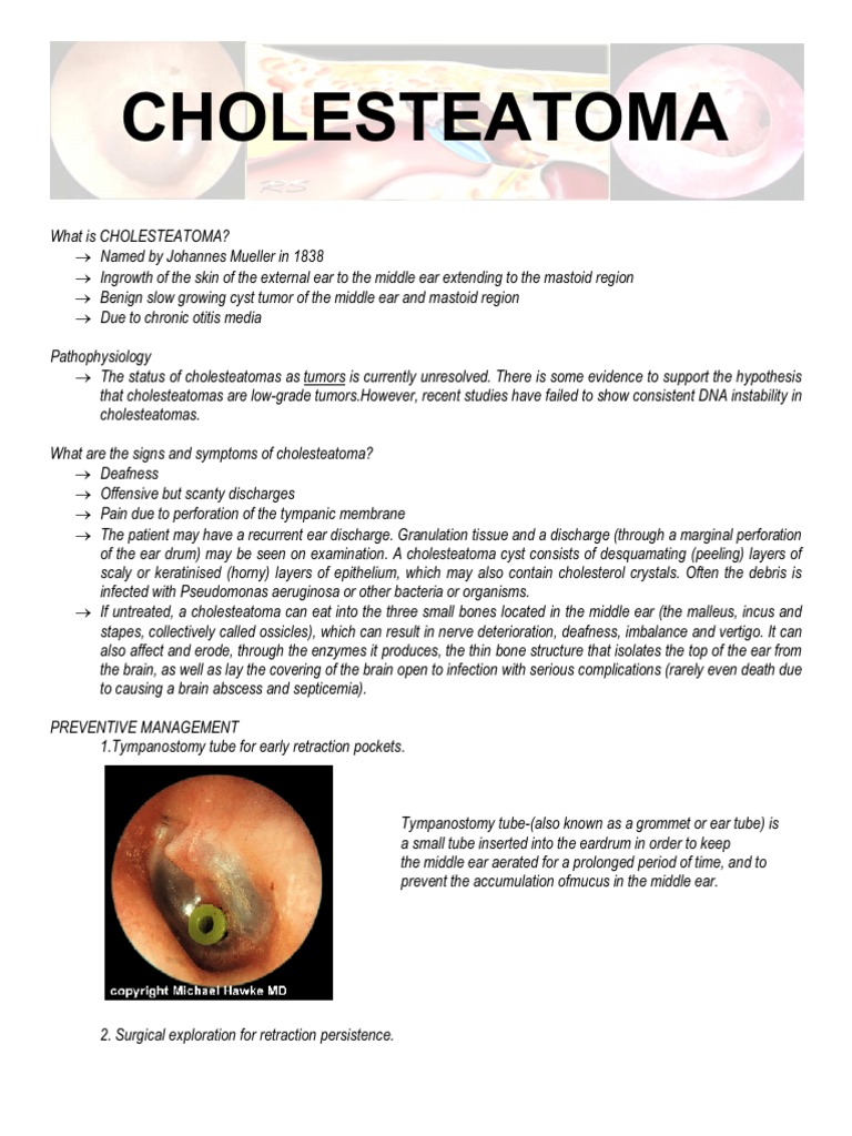 Cholesteatoma Report06 | PDF | Ear | Hearing