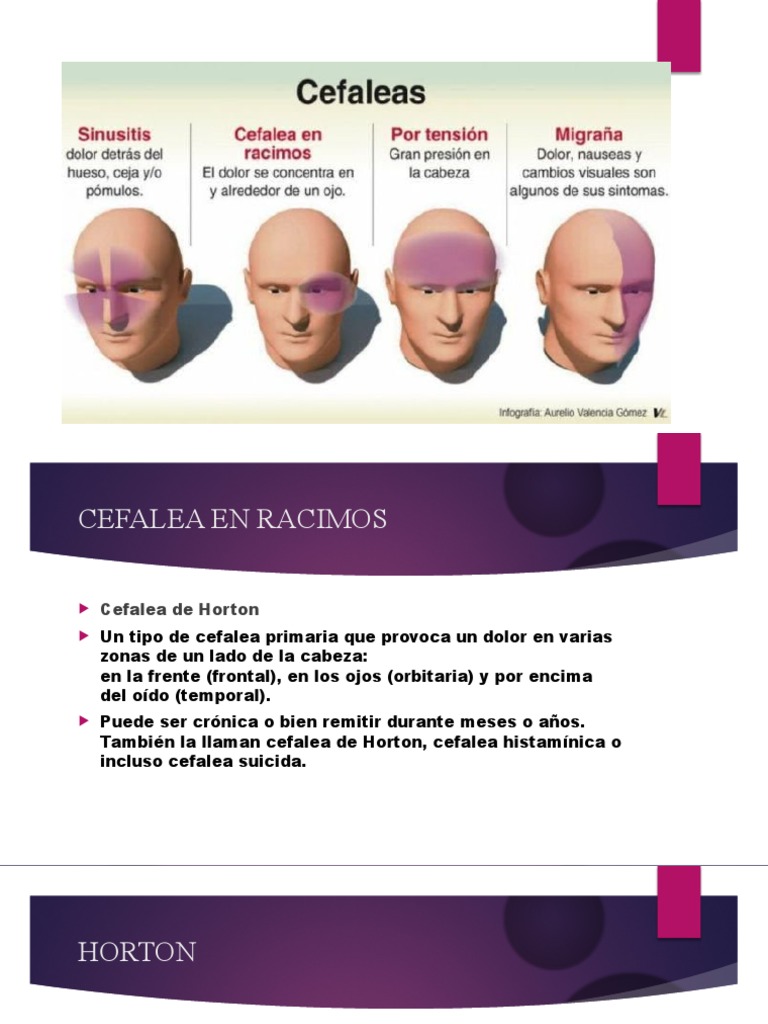 Cefalea en Racimos | PDF | Dolor de cabeza | Especialidades Medicas