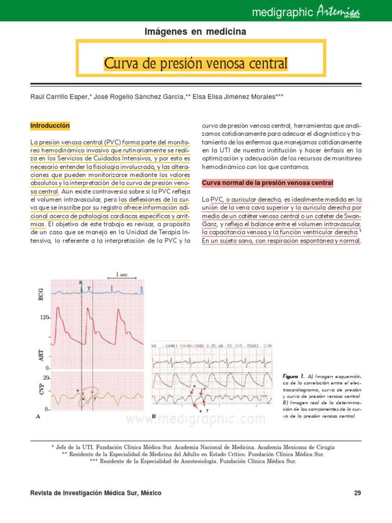 Curva de Presión Venosa Central. 2009, de Medigraphic | PDF | Arritmia ...