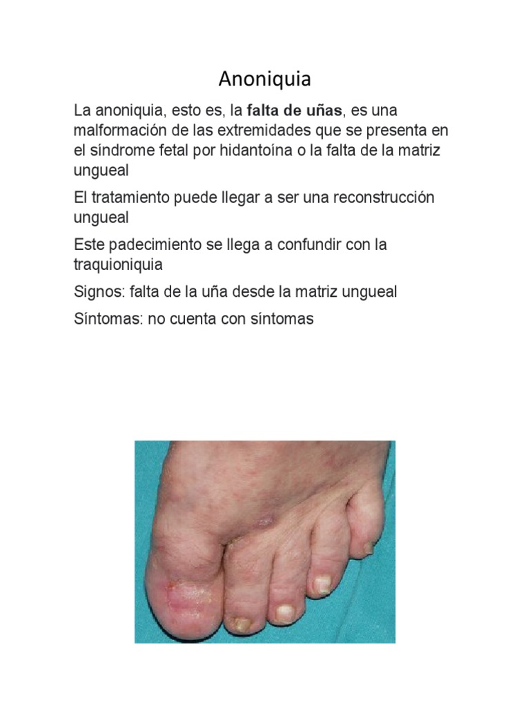 Anoniquia: Causas y Tratamiento | PDF