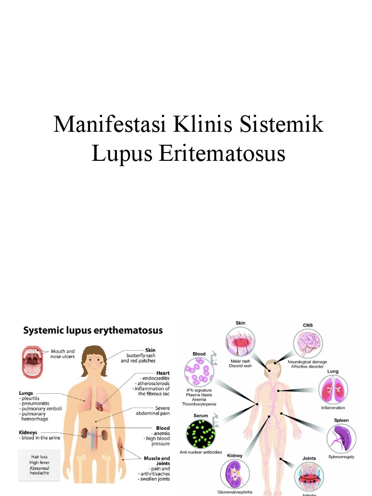 Manifestasi Klinis SLE | PDF