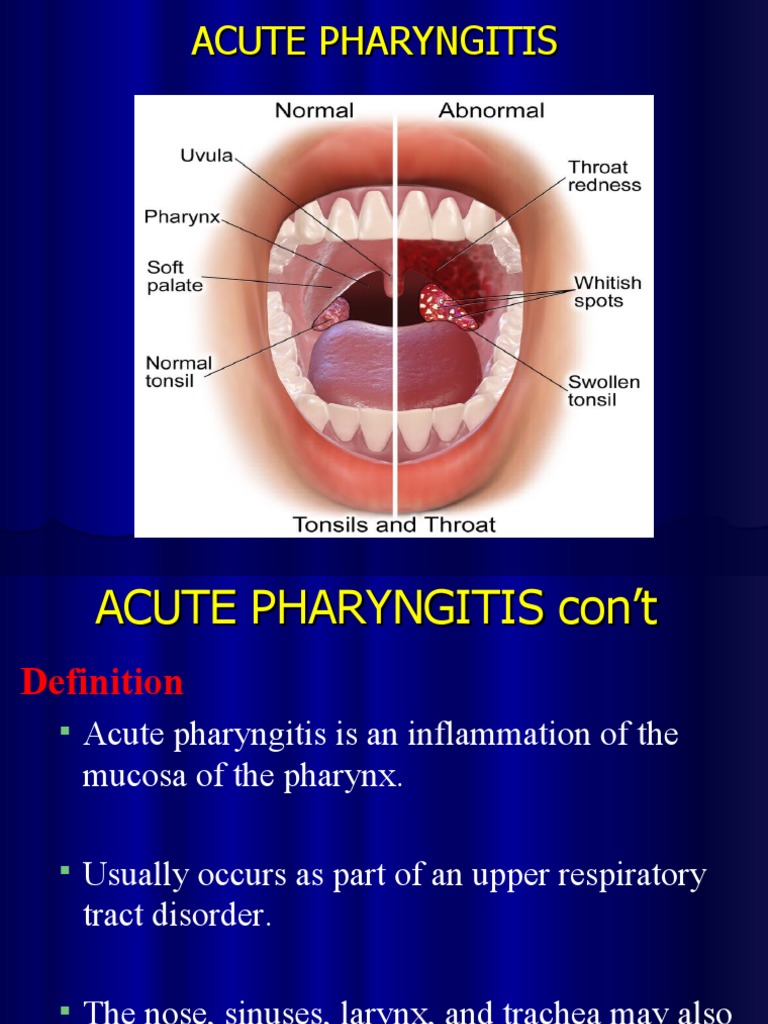 An In-Depth Look at Acute Pharyngitis: Causes, Symptoms, Treatments ...