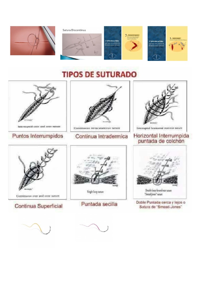 Tipos de Sutura | PDF