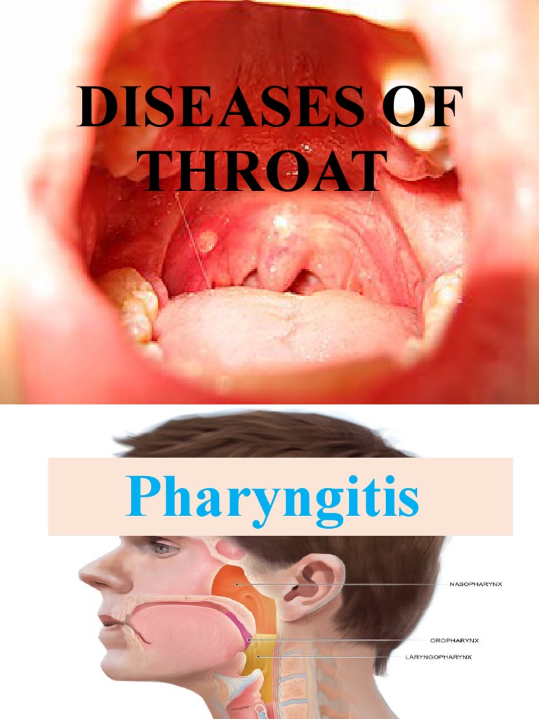Diseases of Throat | PDF | Clinical Medicine | Medical Specialties