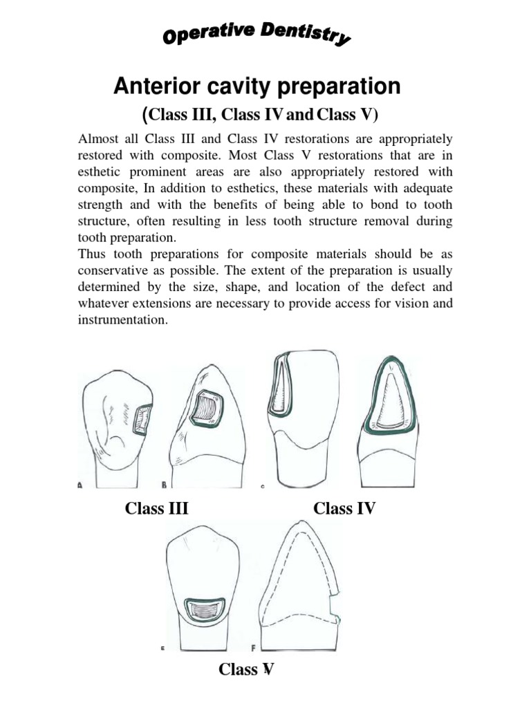 Anterior Cavity Preparation: (Class III, Class IV and Class V) | PDF ...