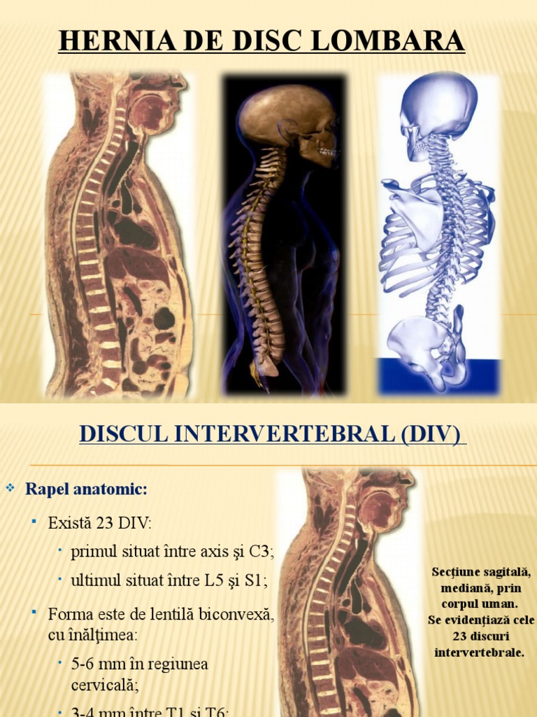 Hernia Disc Lombara | PDF