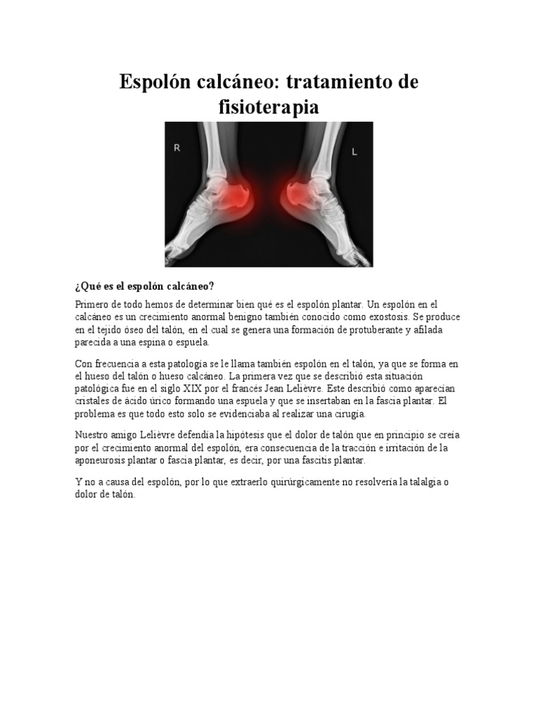 Espolón Calcáneo | PDF | Pie | Dolor