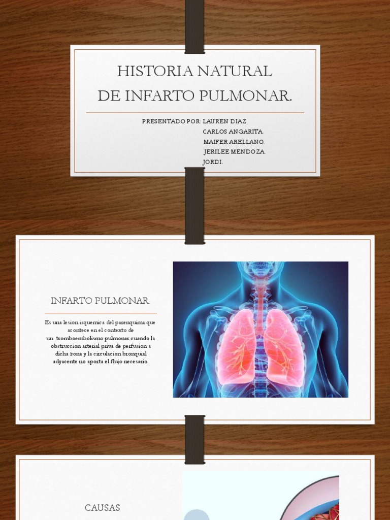 Historia Natural Del Infarto Pulmonar.. PHDN | PDF
