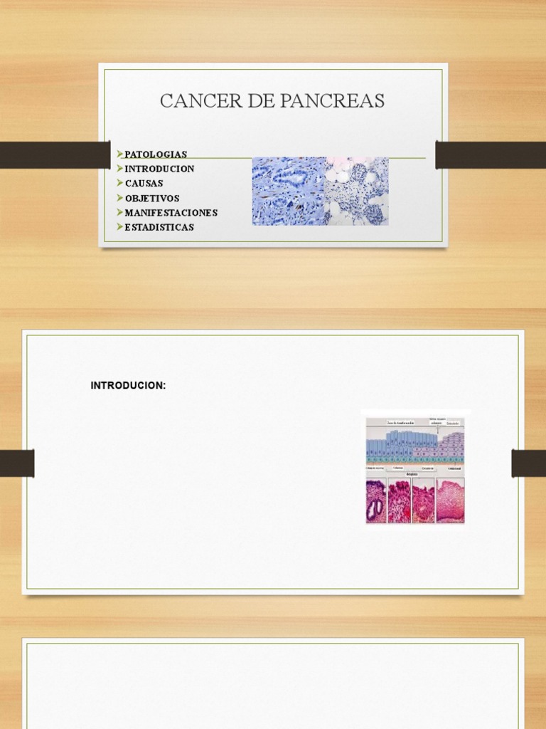 Cancer de Pancreas | PDF