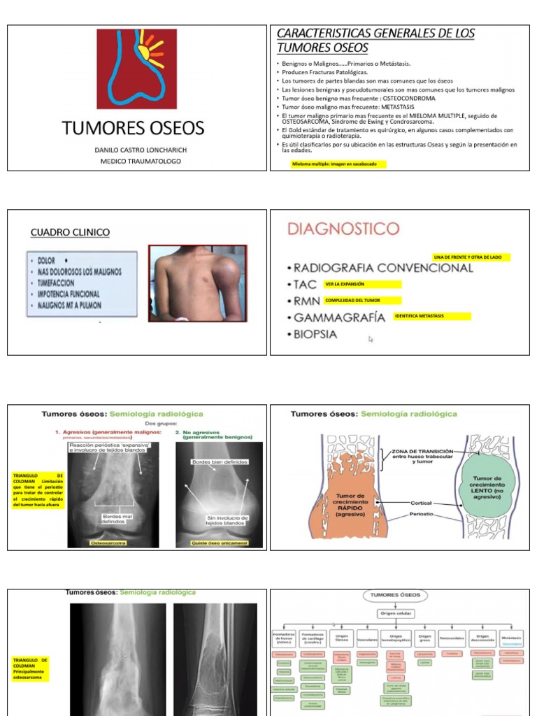 Tumores Oseos | Descargar gratis PDF | Neoplasias | Hueso
