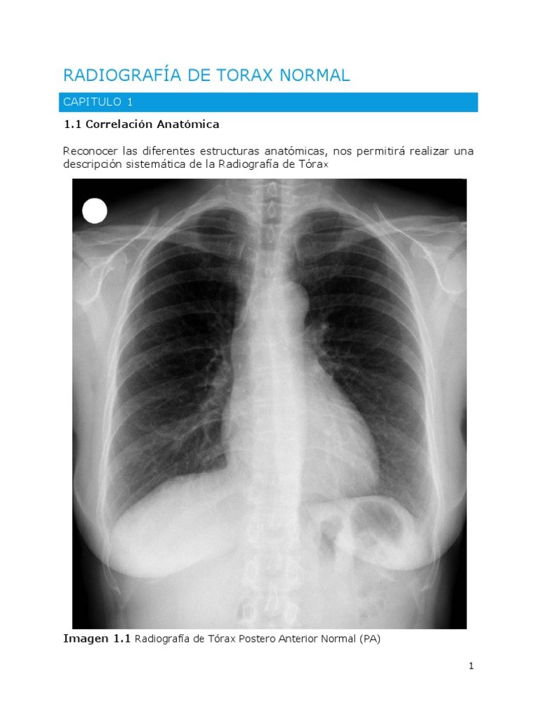 Radiografia De Torax Normal Rotulada