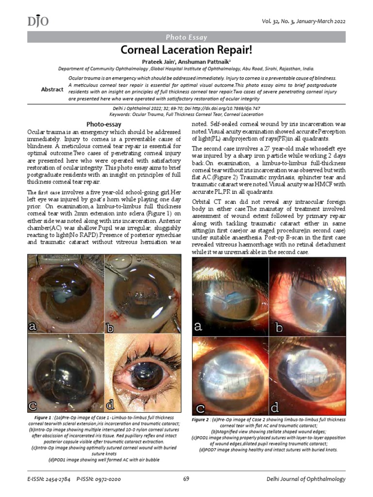 Corneal Laceration Repair Principles | PDF | Cornea | Cataract