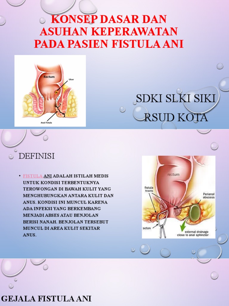 Fistula Ani | PDF