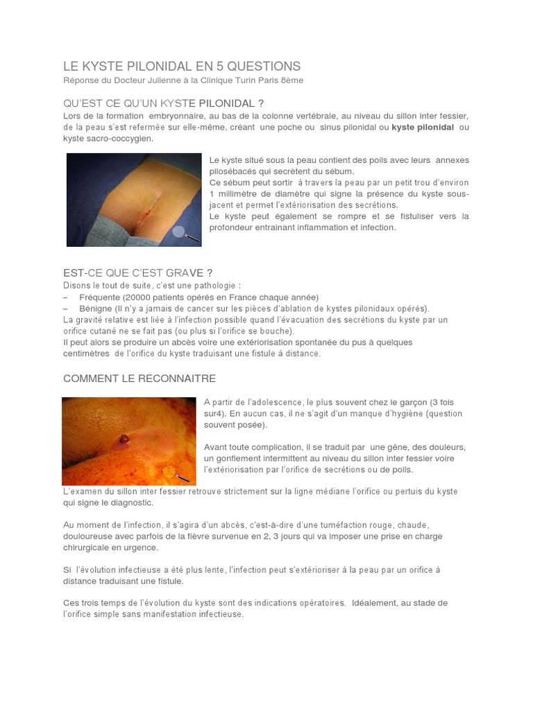 Kyste Pilonidal : Reconnaissance et Traitement | PDF | Infection ...
