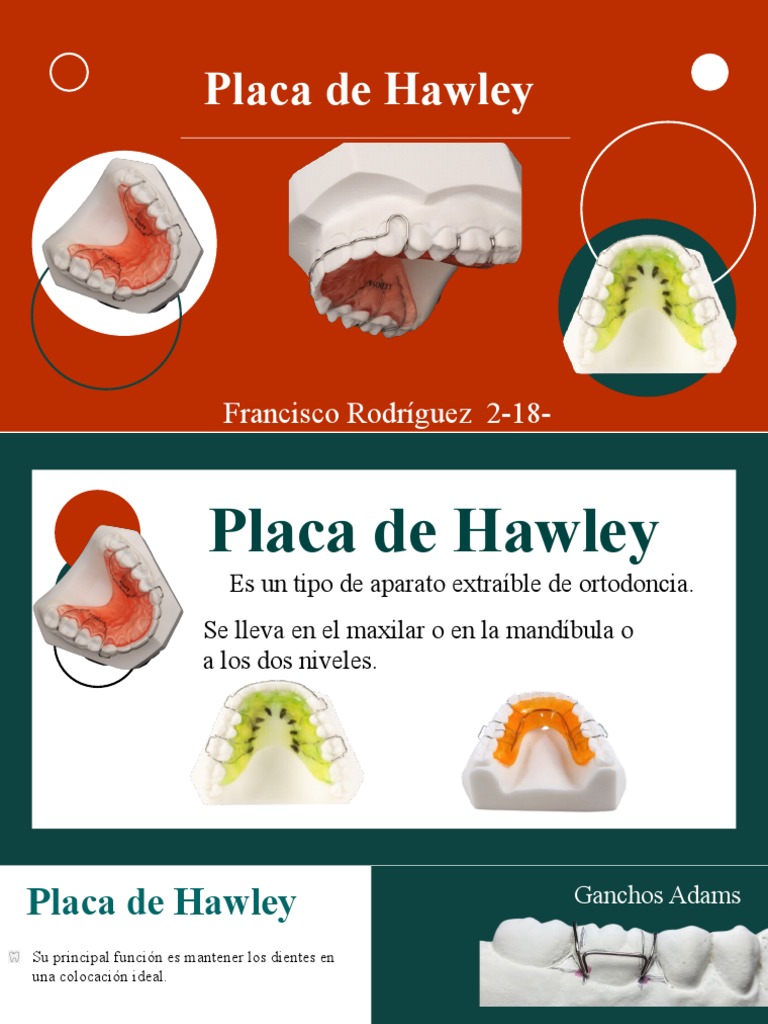 Placa de Hawley | PDF | Ortodoncia | Diente