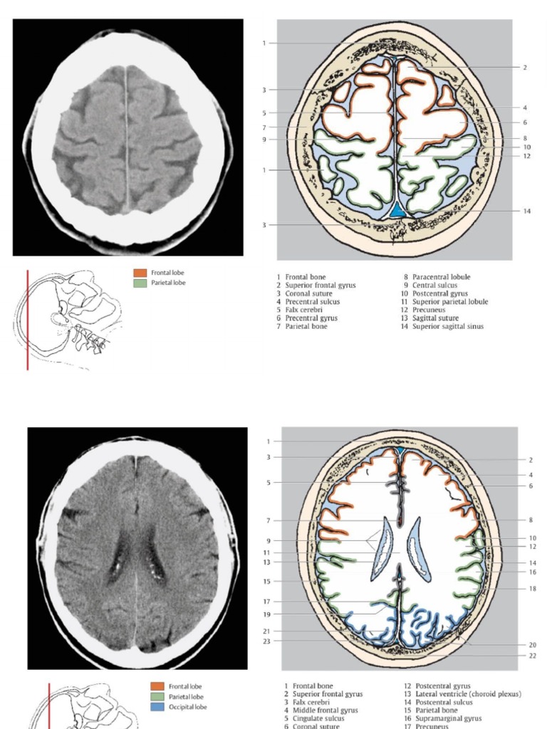 Anatomi CT Scan Kepala - Velia Tcelinnd | PDF