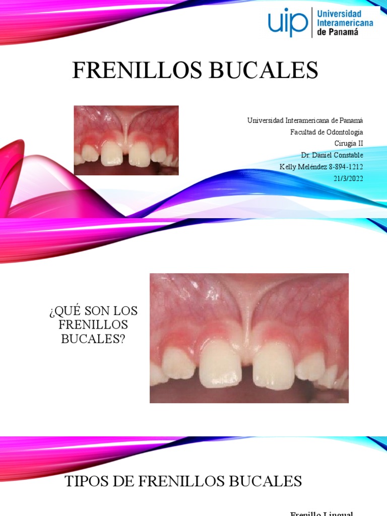 Frenillos Bucales Cirugia2 | PDF | Ortodoncia | Cirugía