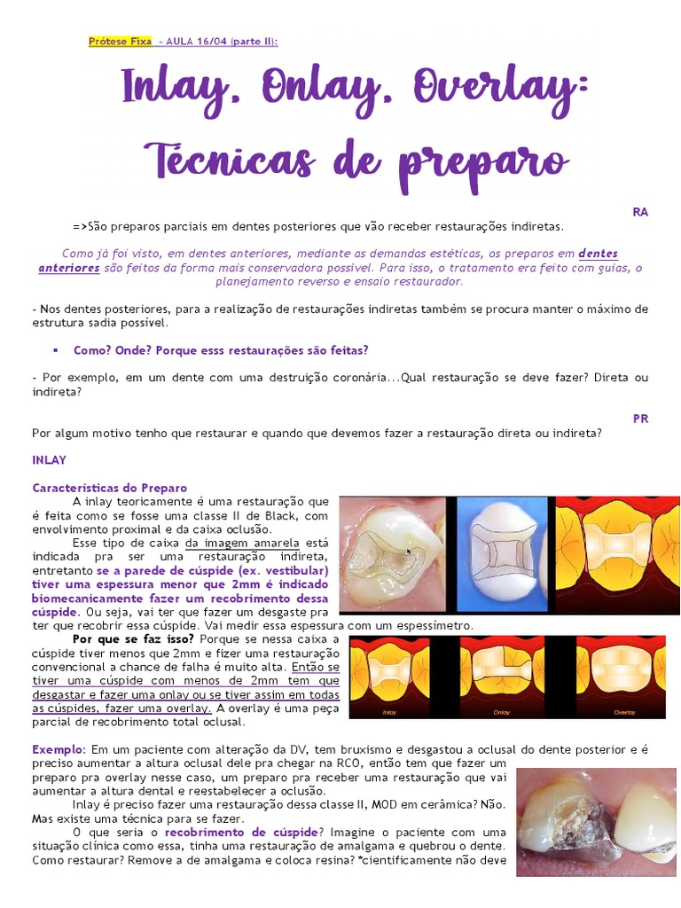 7 - Prótese Fixa - Inlays, Onlay e Overlay - Técnica de Preparo - 16.04 ...