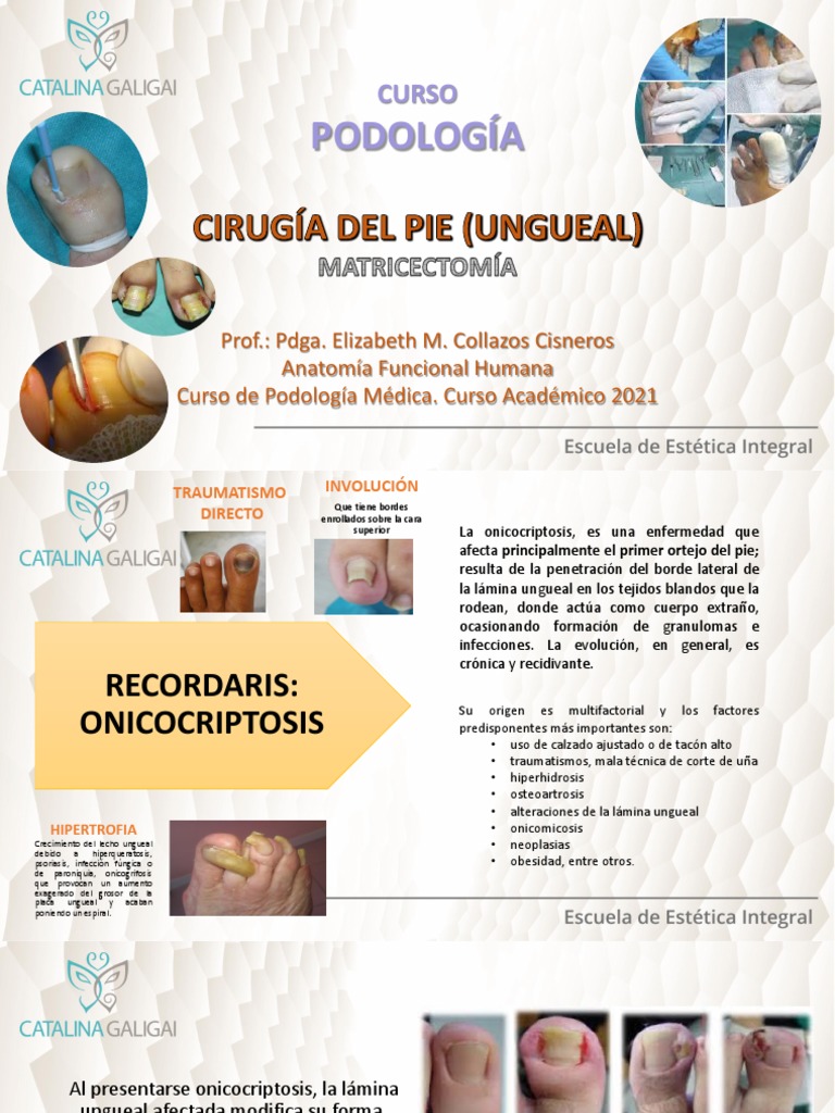 Matricectomía: Técnicas y Consideraciones | PDF | Clavo (anatomía ...