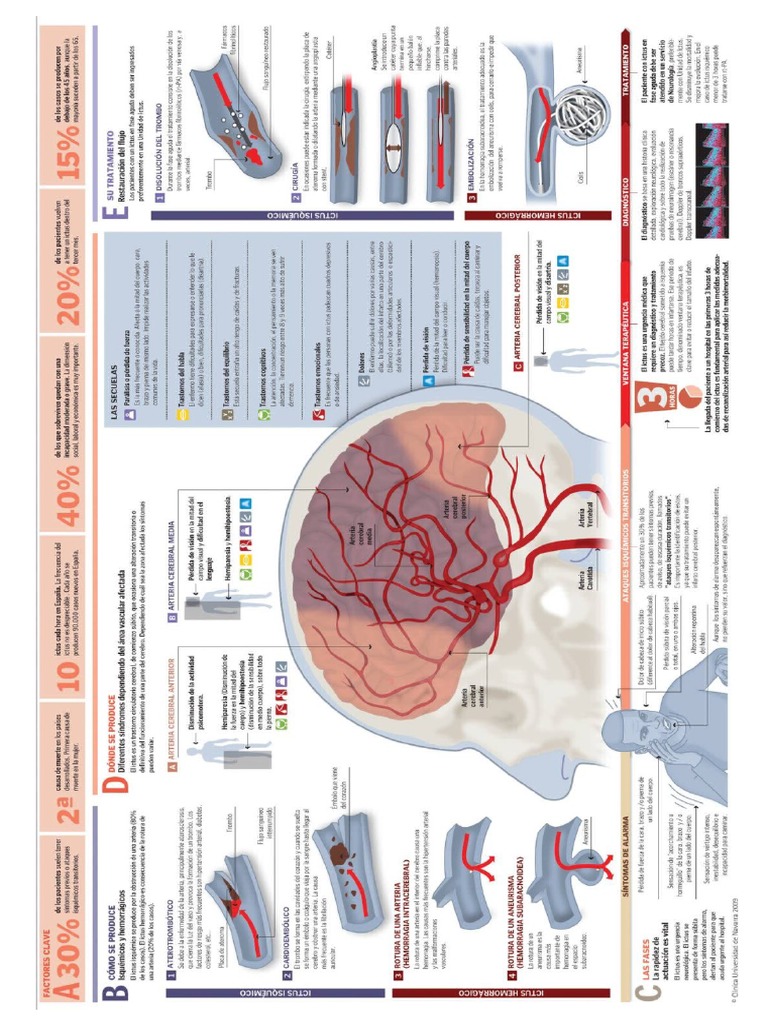 Infografico Ictus | PDF