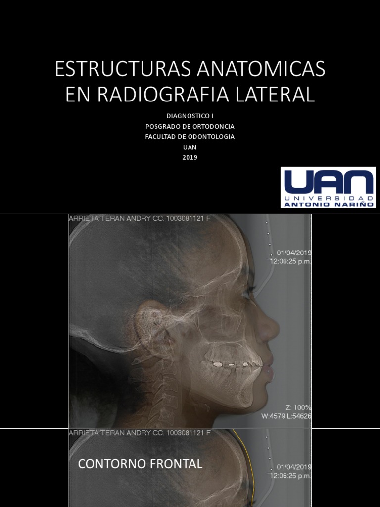 Anatomía De La Radiografía Lateral Del Cráneo AP Lateral De Craneo