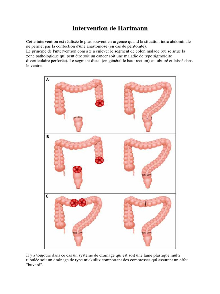 Intervention de Hartmann | PDF