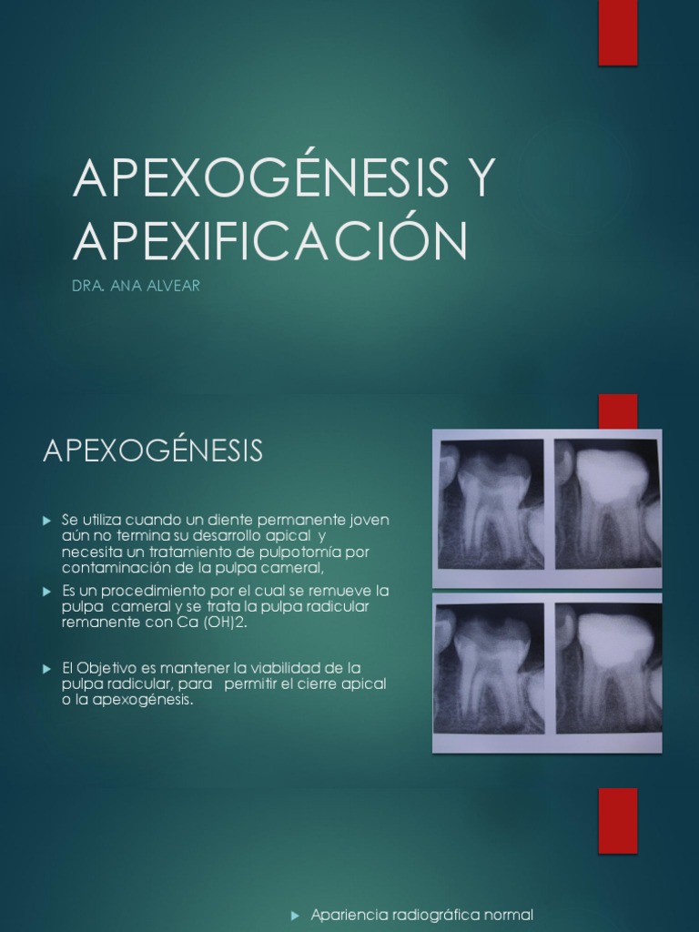 Apexogénesis y Apexificación | PDF | Especialidades Medicas ...