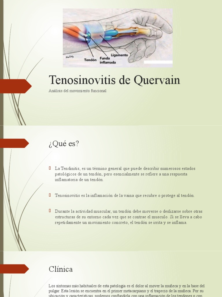 Tenosinovitis de Quervain | PDF | Trastornos musculoesqueléticos ...