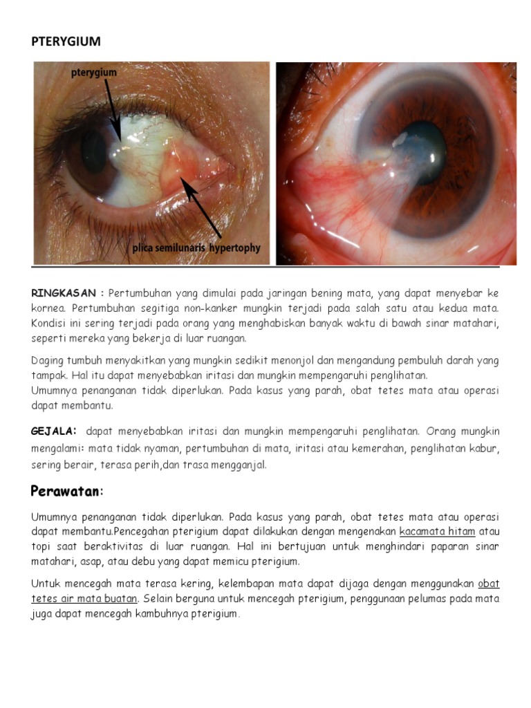 PTERYGIUM | PDF