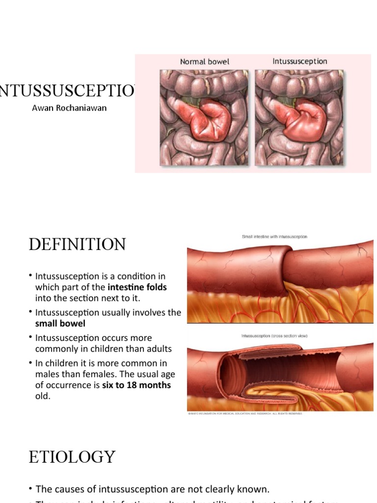 Intussusception: Awan Rochaniawan | PDF | Medical Specialties ...