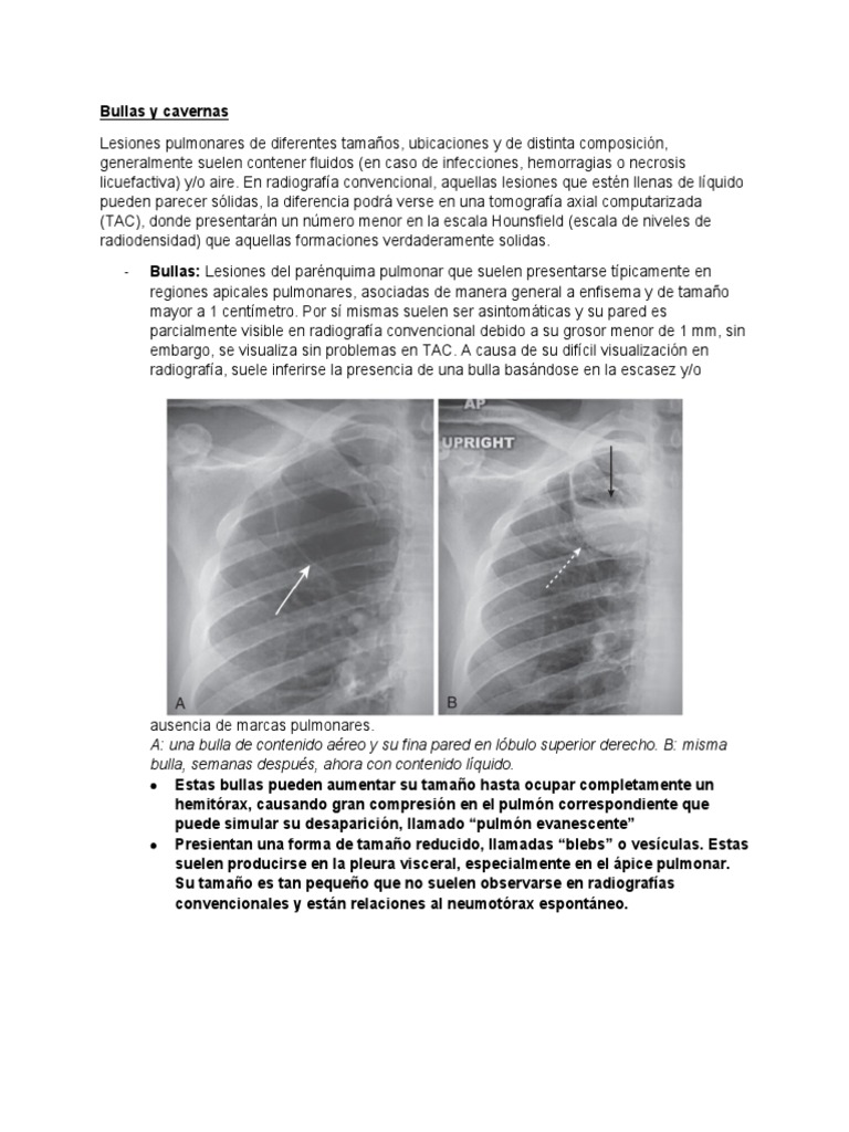 Bullas y Cavernas en Lesiones Pulmonares | PDF | Pulmón | Ct Scan
