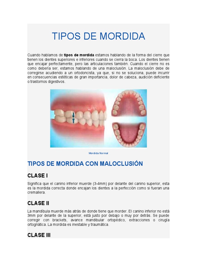 Tipos de Mordida y Maloclusiones | PDF | Ortodoncia | Especialidades ...