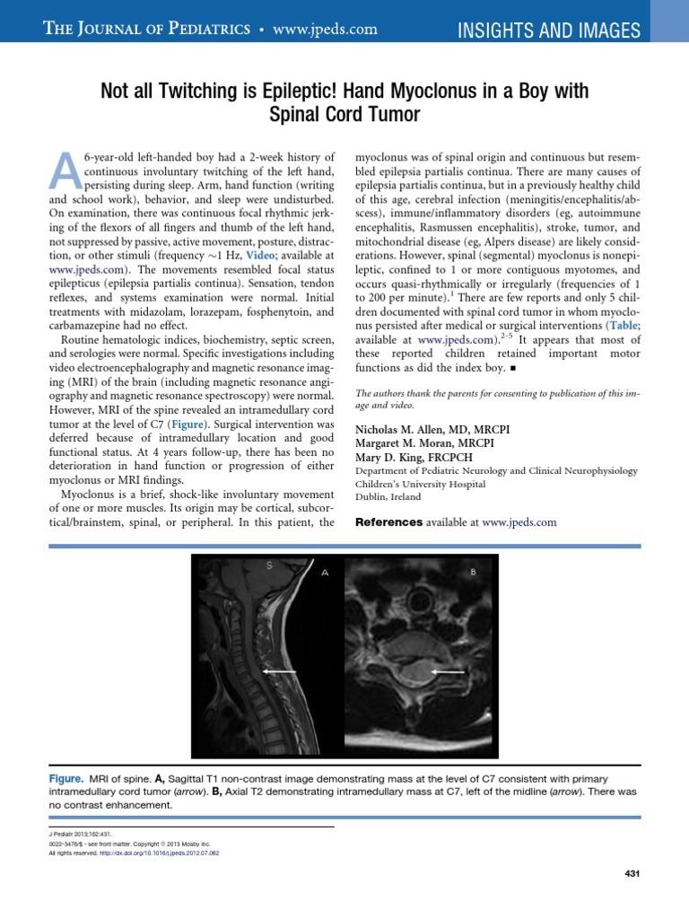 Not All Twitching Is Epileptic! Hand Myoclonus in A Boy With | PDF ...