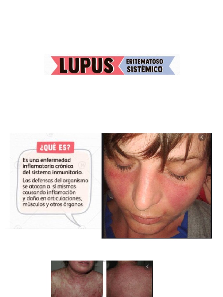Lupus Eritematoso y Penfigo | PDF | Inmunología | Medicina