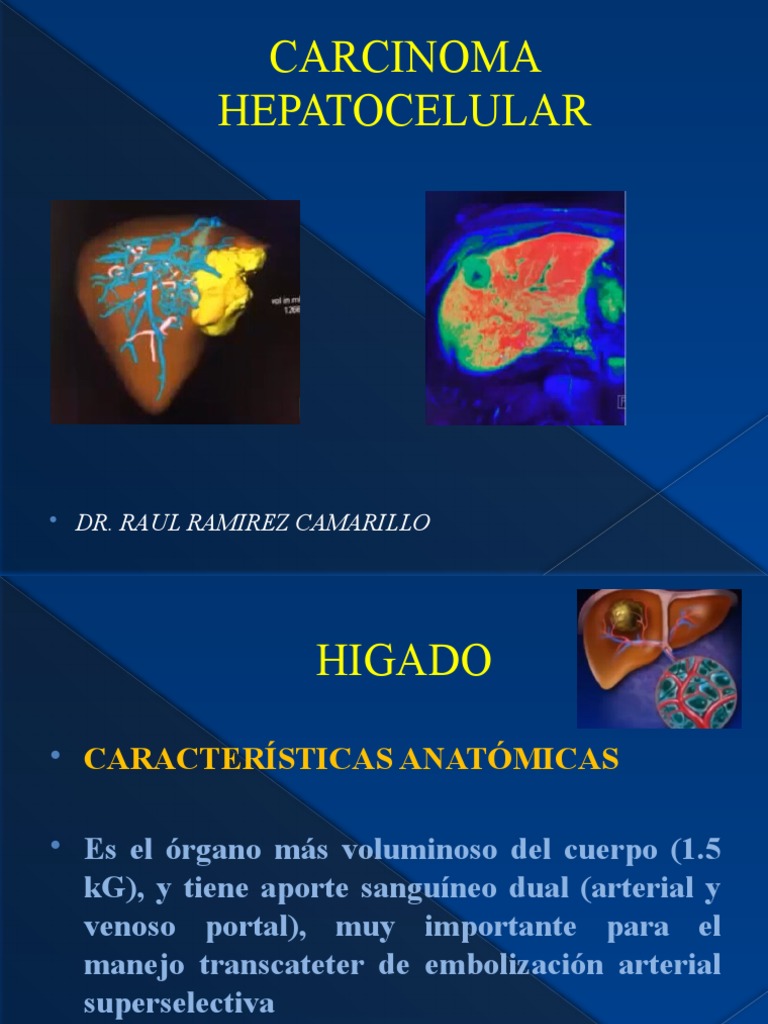 Carcinoma Hepatocelular | PDF | Cirrosis | Hepatitis