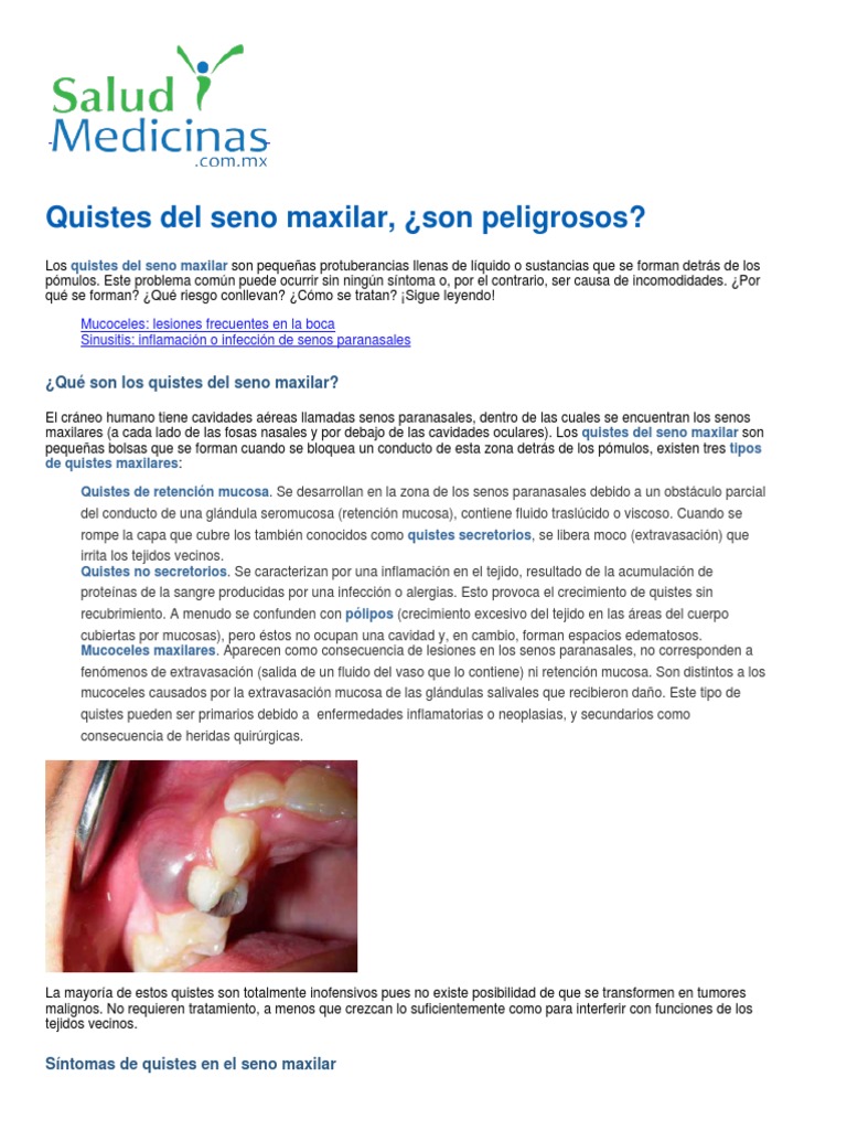 Quistes Seno Maxilar Peligrosos | PDF | Pecho | Epidemiología