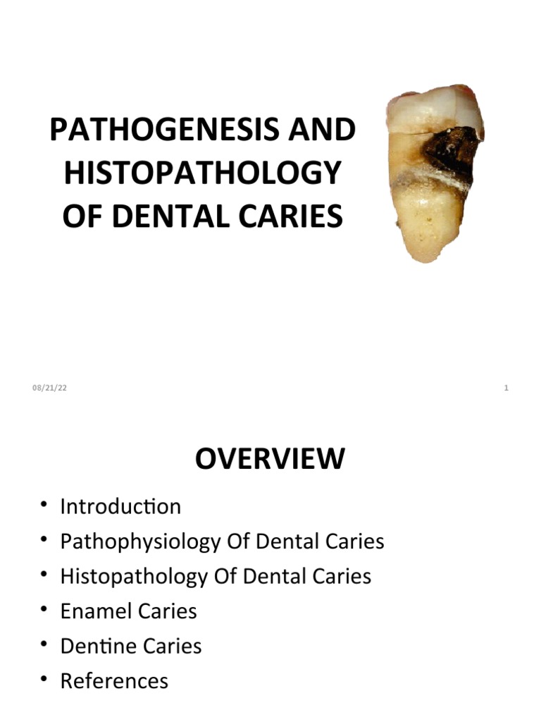Pathophysiology and Histopathology of Dental Caries-Edited | PDF ...