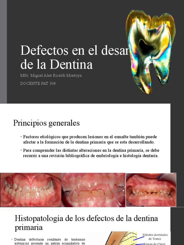 Defectos en el desarrollo de la dentina: una revisión de las principales alteraciones ...