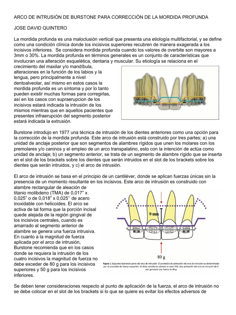 ARCO DE INTRUSIÓN DE BURSTONE PARA CORRECCIÓN DE LA MORDIDA PROFUNDA ...