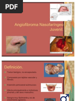 Tumores de Nariz y Senos Paranasales Subrayado | PDF | Cáncer | Sarcoma