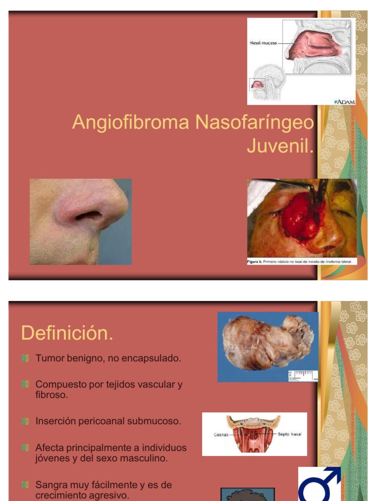Angiofibroma Nasofaríngeo Juvenil | PDF