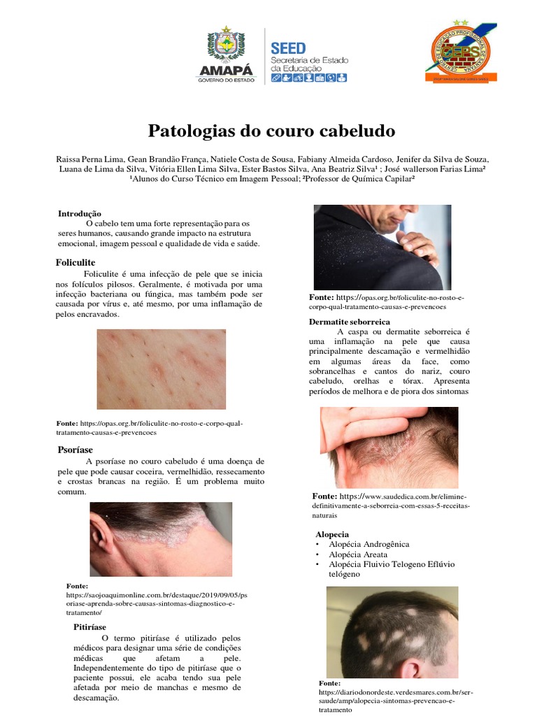 Patologias Do Couro Cabeludo | PDF | Psoríase | Perda de cabelo