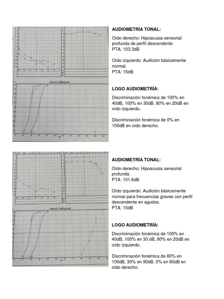 Audiometrias Tonales | PDF