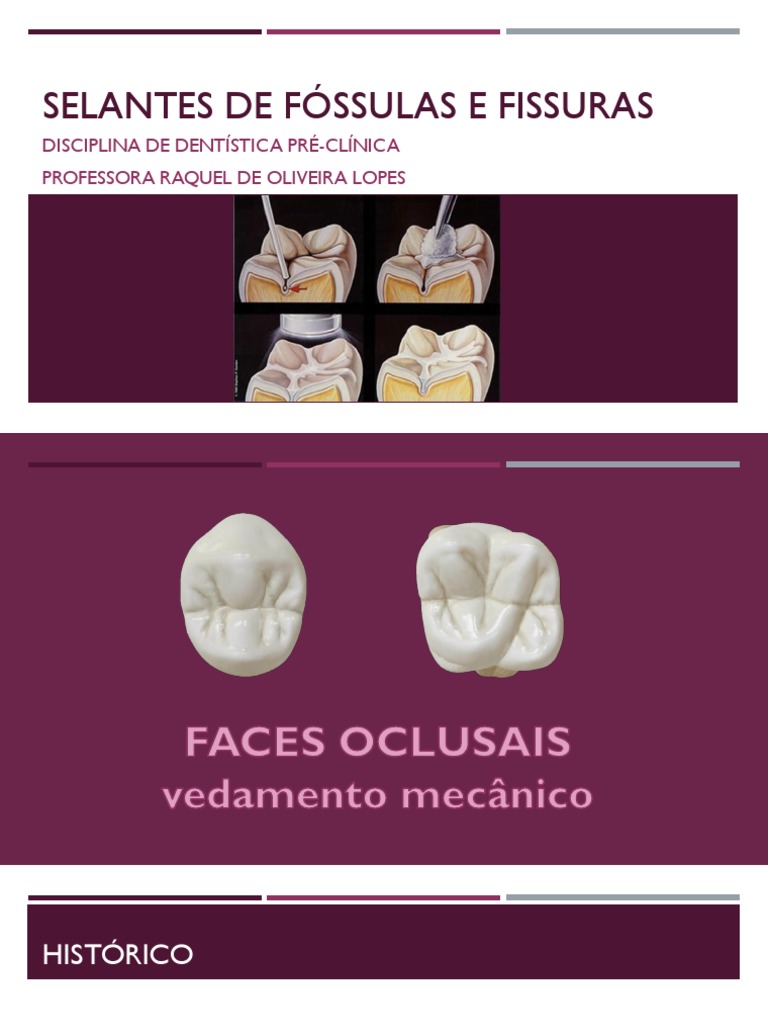 SELANTES DE FÓSSULAS E FISSURAS | PDF | Odontologia | Ciências da Saúde