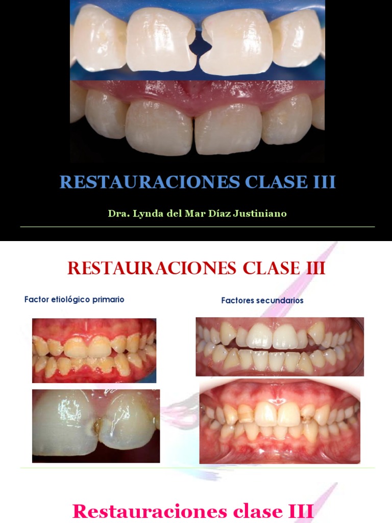 Restauraciones Clase Iii | PDF | Esmalte de dientes | Diente