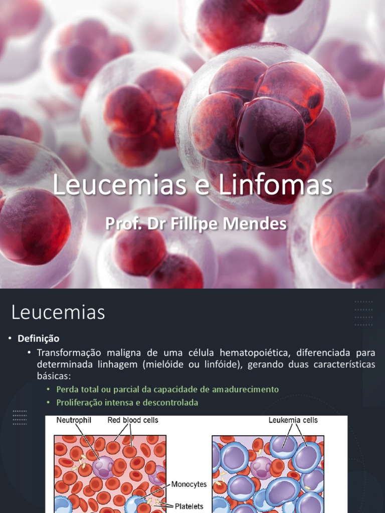Aula 4 Leucemias e Linfomas | PDF | Leucemia | Linfoma
