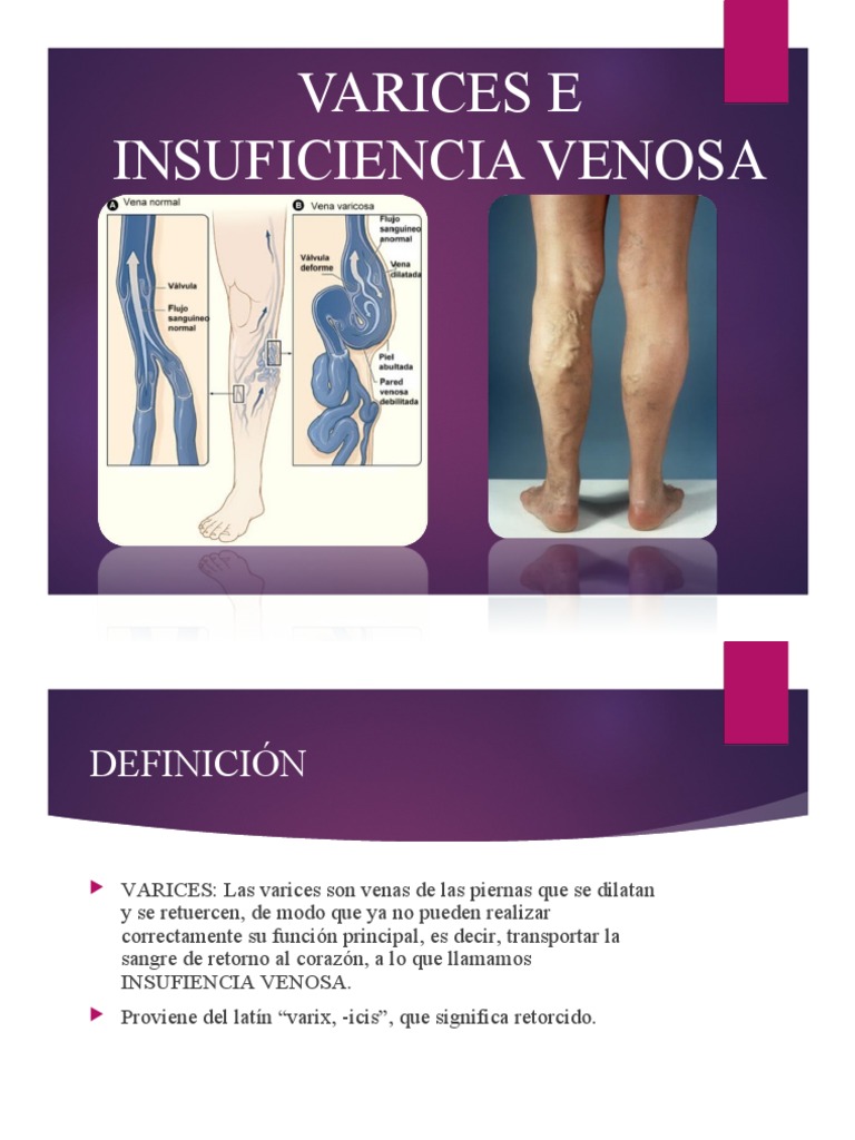 Varices e Insuficiencia Venosa | PDF | Venas varicosas | Enfermedades y ...